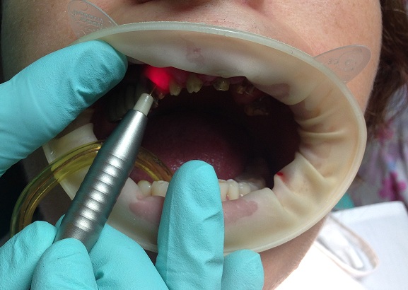 CHIURETAJ SI GINGIVOPLASTIE – Activ Dent – Cabinet Stomatologie in ...